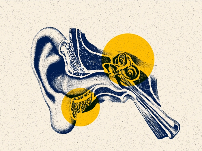 Vocal Fold Lesions, Nodules, Cysts & Polyps | University of Michigan Health