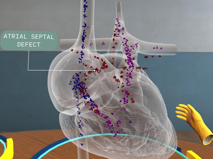 Pulmonary Embolism & CTEPH | University of Michigan Health